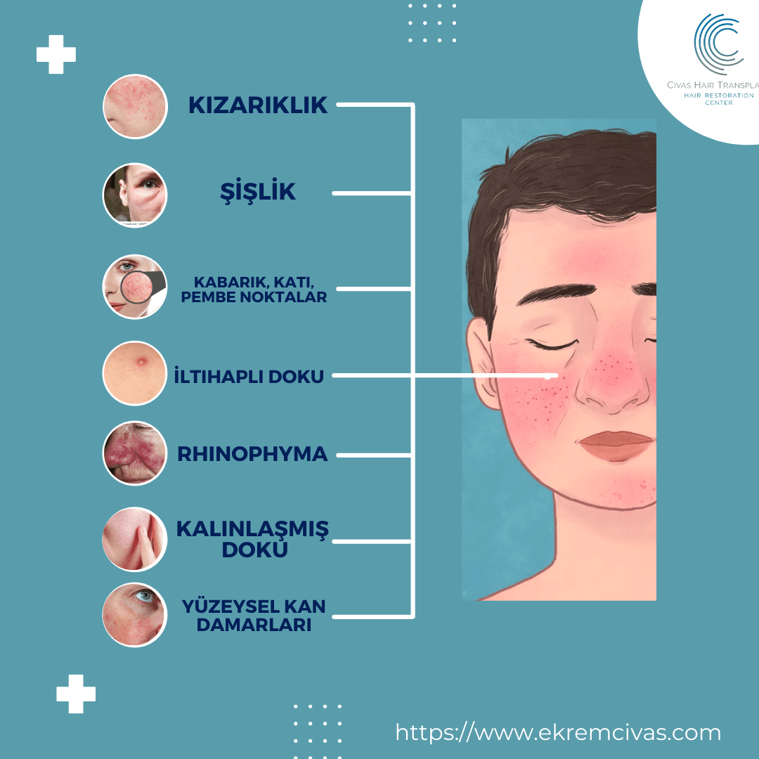 Rozasea Tedavisinde Yenilikler, Lazer ve Botulinum Toksin (Botoks ...