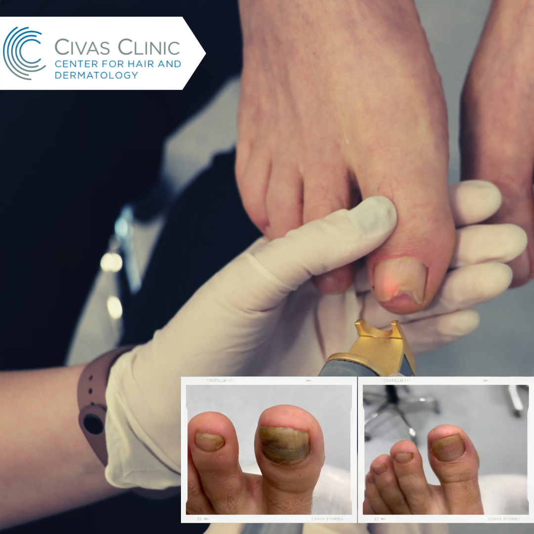 Lazerle Tırnak Mantarı Tedavisi | Doç. Dr. Ekrem Civas | Ankara
