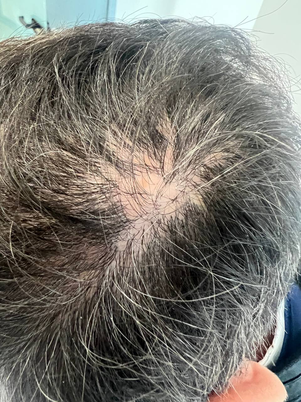 Liken Pilanopilaris | Doc.Dr.Ekrem Civas