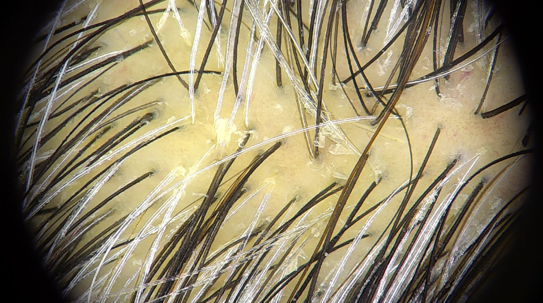 Seboreik Dermatit Belirtileri ve Tedavisi | Doc.Dr. Ekrem Civas