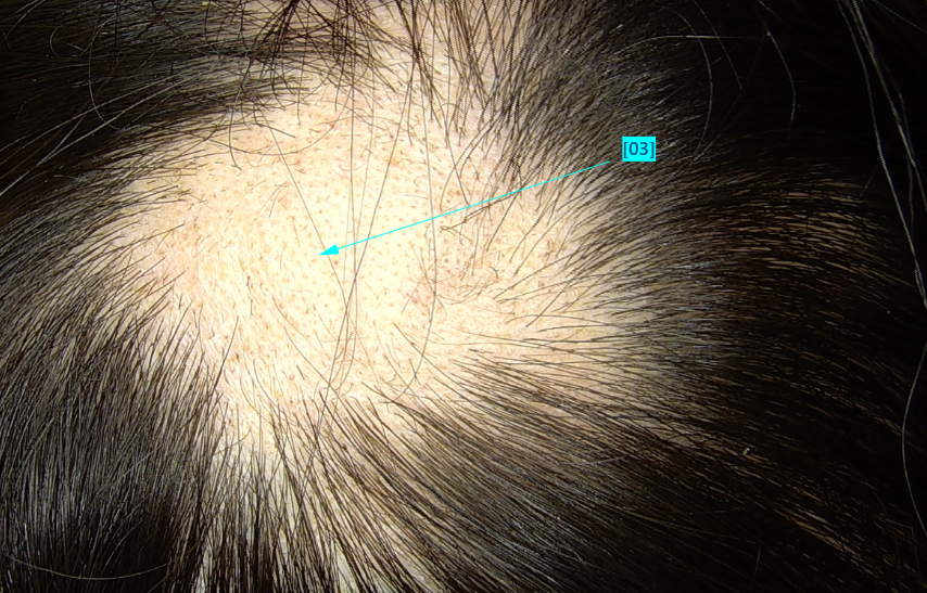 Hair transplantation in scar alopecia | Doç.Dr. Ekrem Civas - Ankara