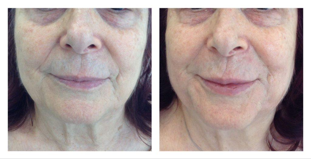 Volume and Skin Renewal with Crystal Filling | Doç.Dr.Ekrem Civas